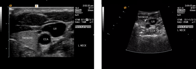 Ultrasound Physics | Neuraxiom
